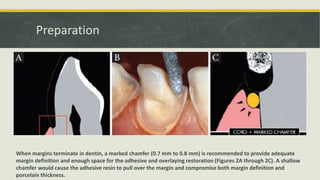 ImmediateDentinSealing.pptx