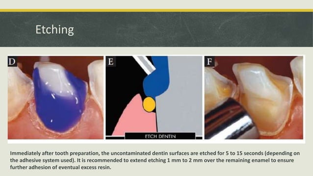 ImmediateDentinSealing.pptx | Dental Health | Diseases and Conditions