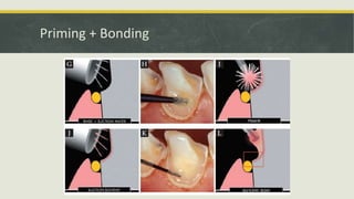 ImmediateDentinSealing.pptx