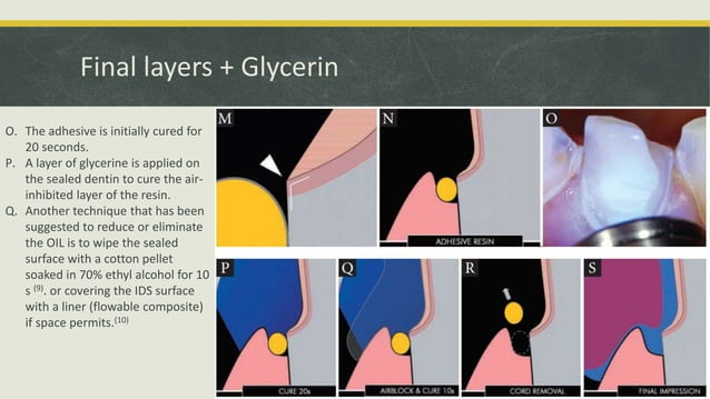 ImmediateDentinSealing.pptx | Dental Health | Diseases and Conditions