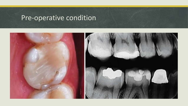 ImmediateDentinSealing.pptx | Dental Health | Diseases and Conditions