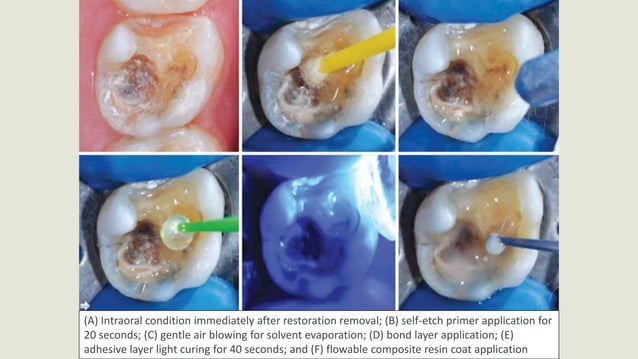 ImmediateDentinSealing.pptx | Dental Health | Diseases and Conditions