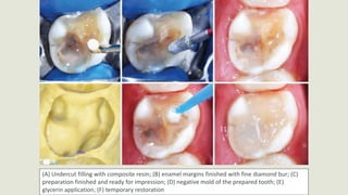 ImmediateDentinSealing.pptx