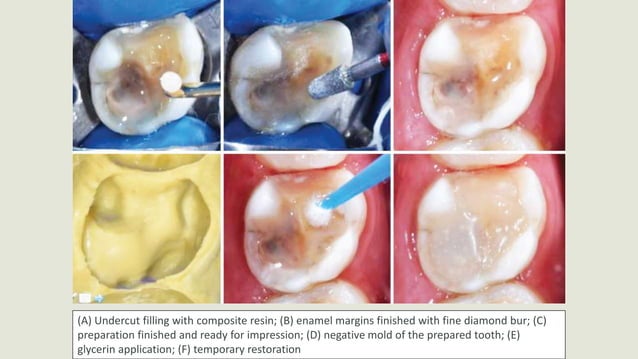 ImmediateDentinSealing.pptx | Dental Health | Diseases and Conditions