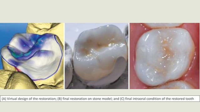 ImmediateDentinSealing.pptx | Dental Health | Diseases and Conditions