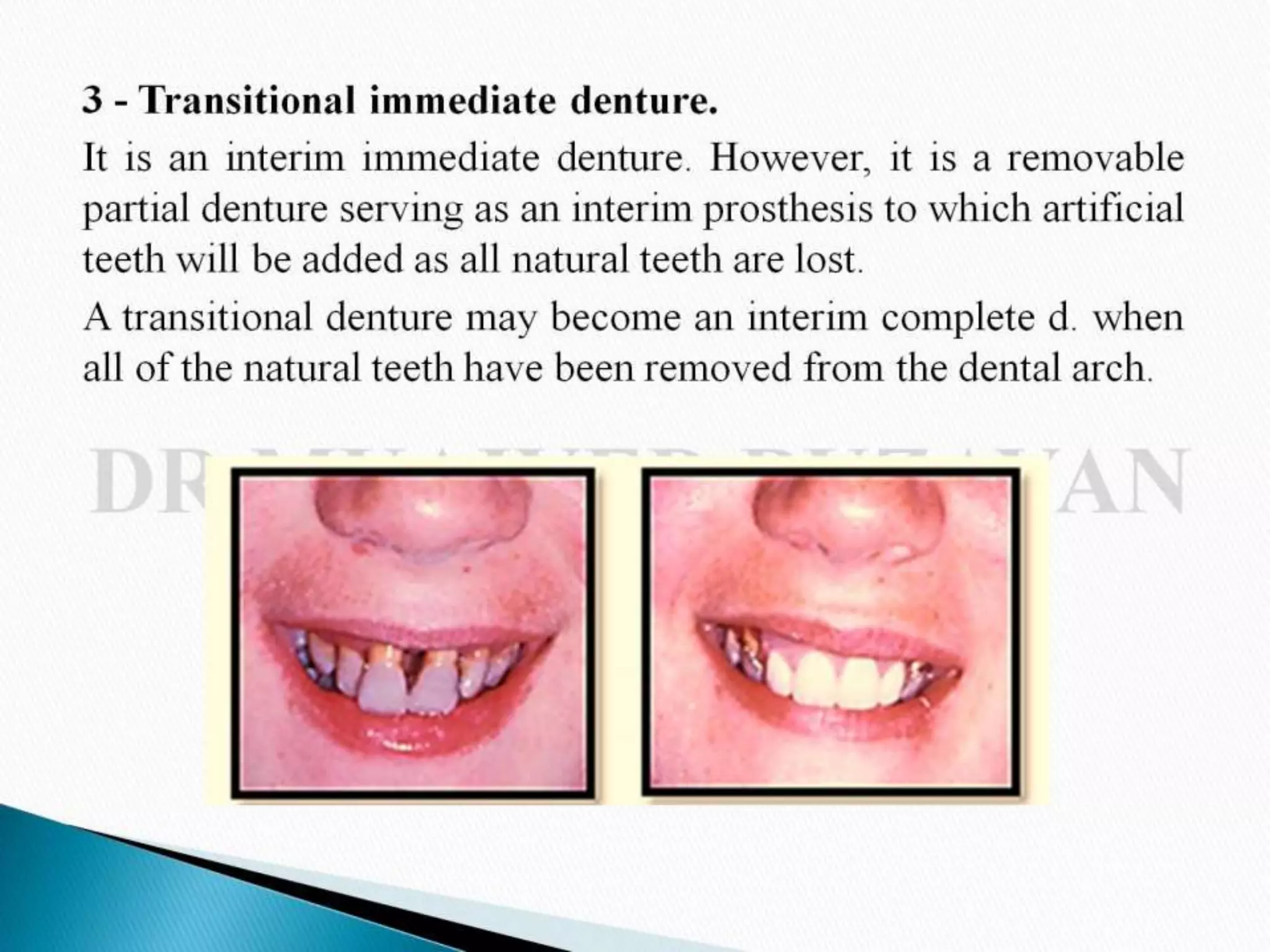 Immediate denture | PPTX