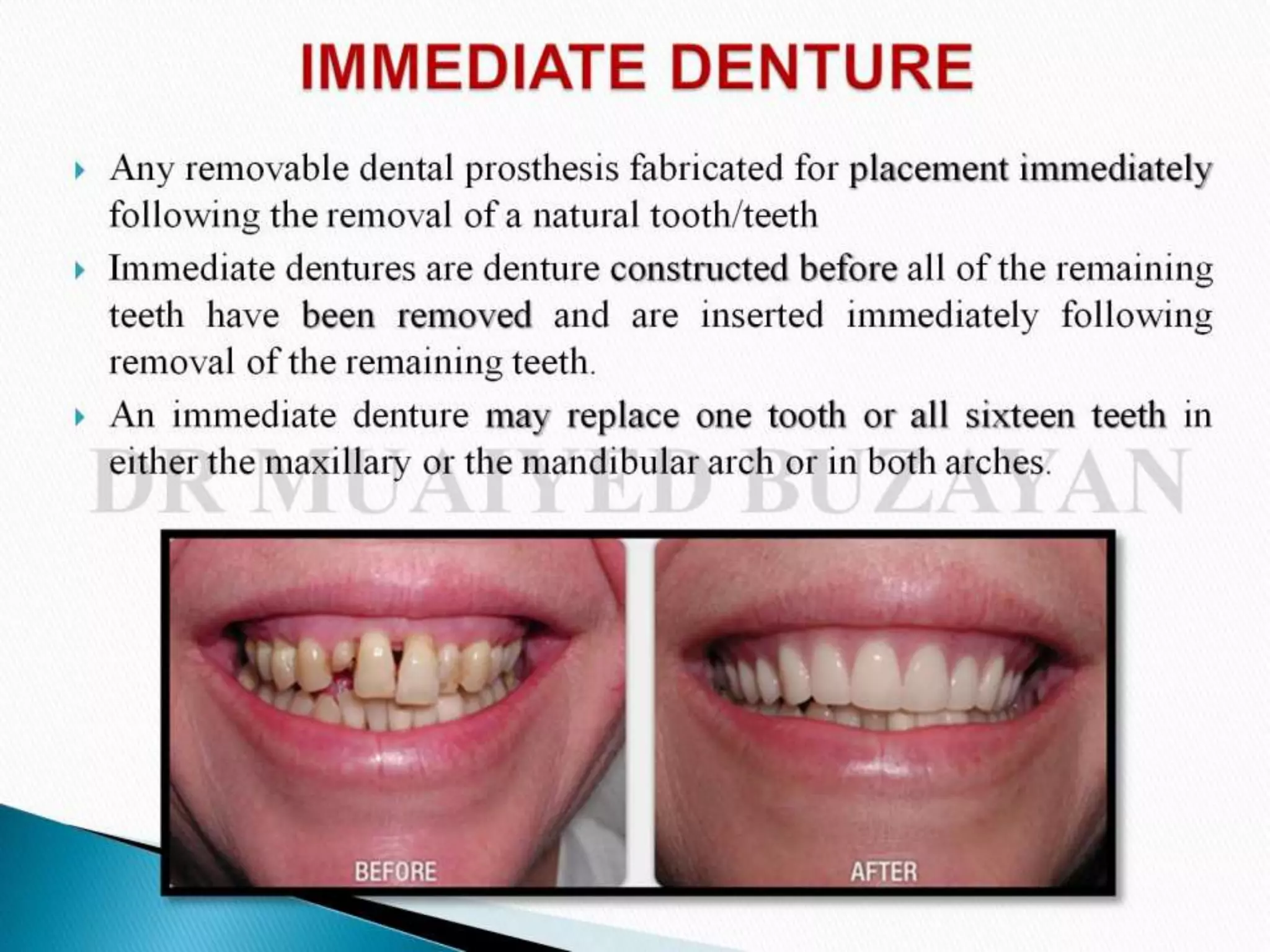 Immediate denture | PPTX