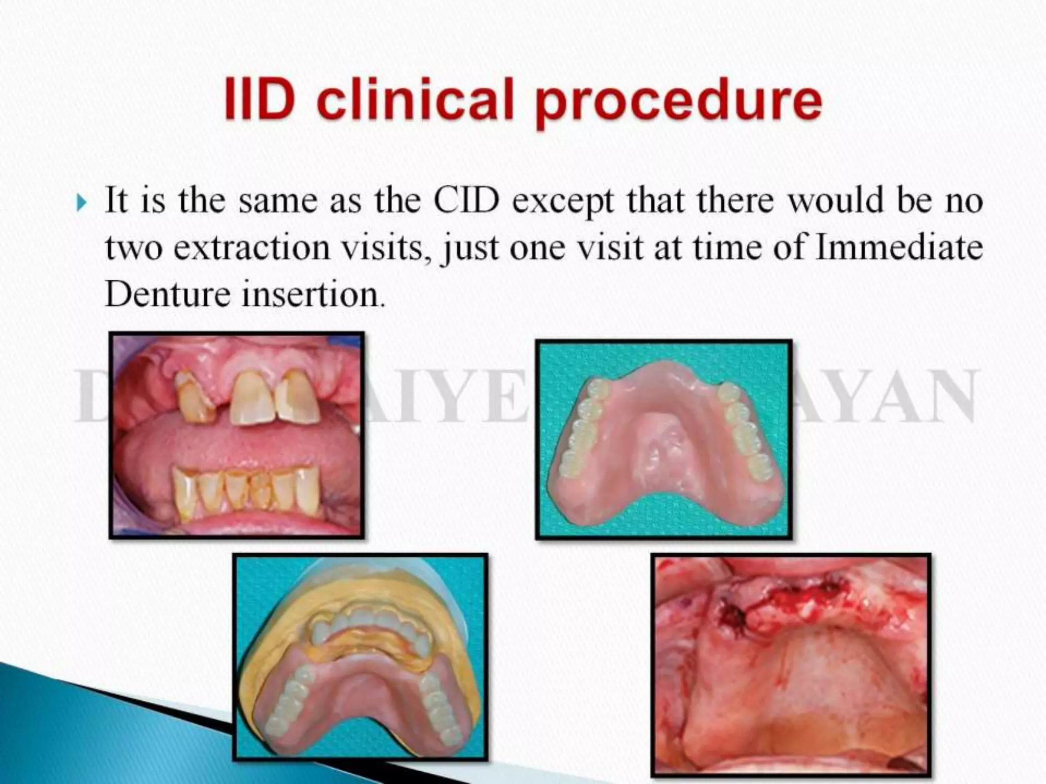 Immediate denture | PPTX