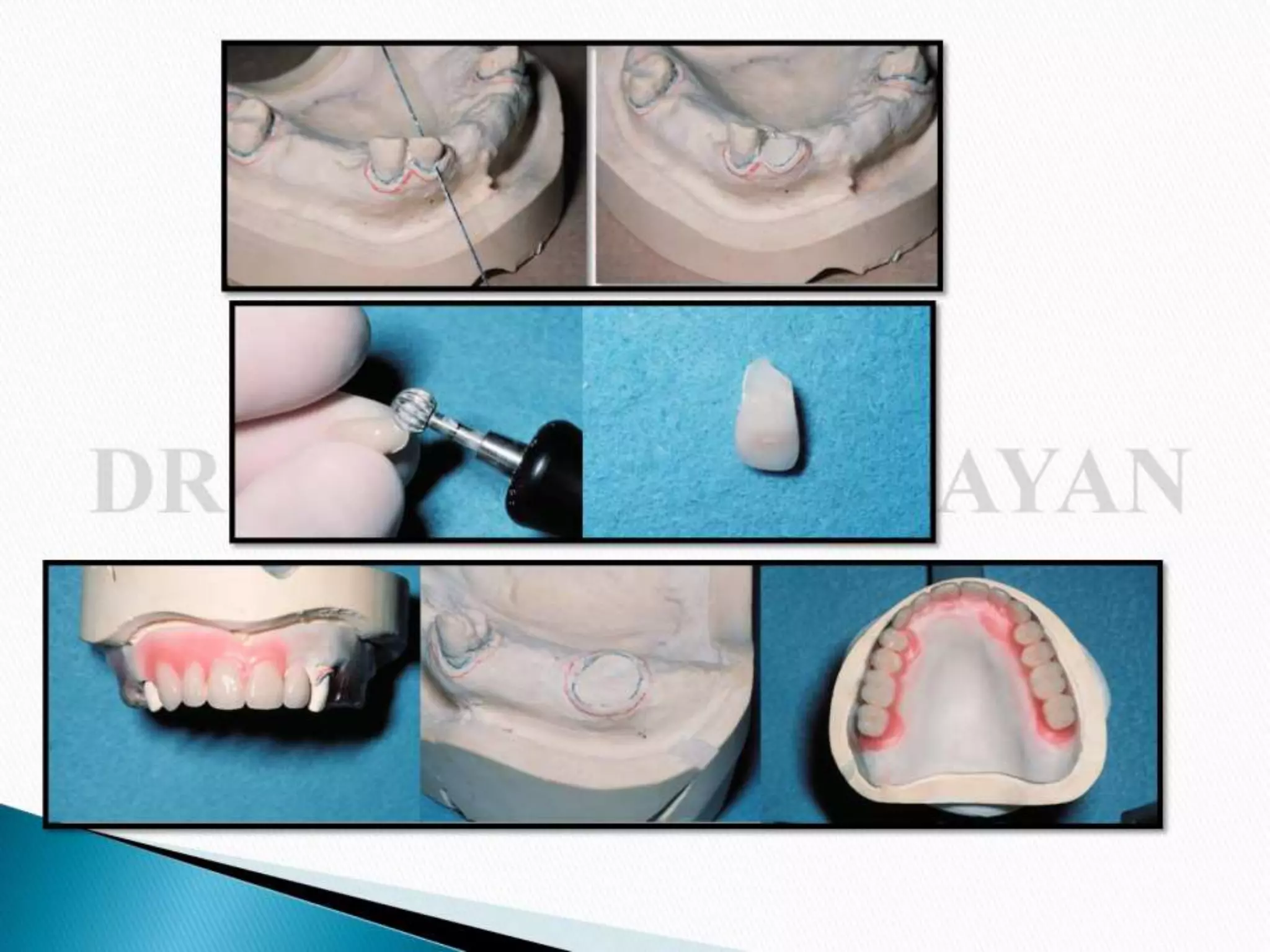 Immediate denture | PPTX