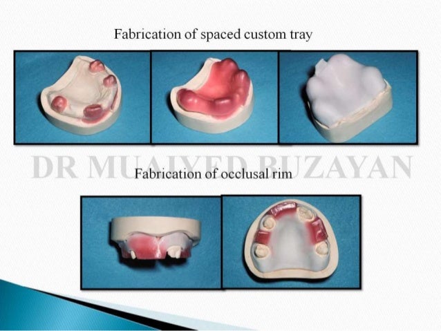 Immediate Dentures Steps