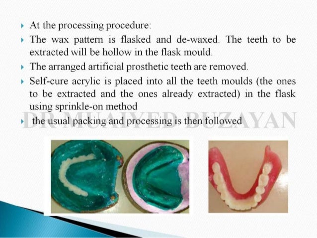 Immediate denture