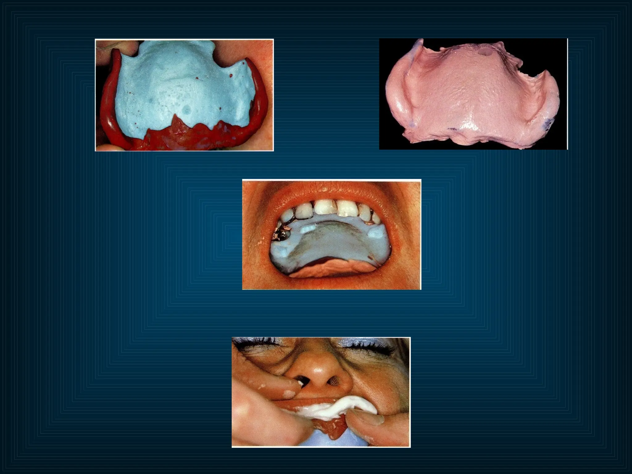 immediate denture part 1 modified (2024).ppt