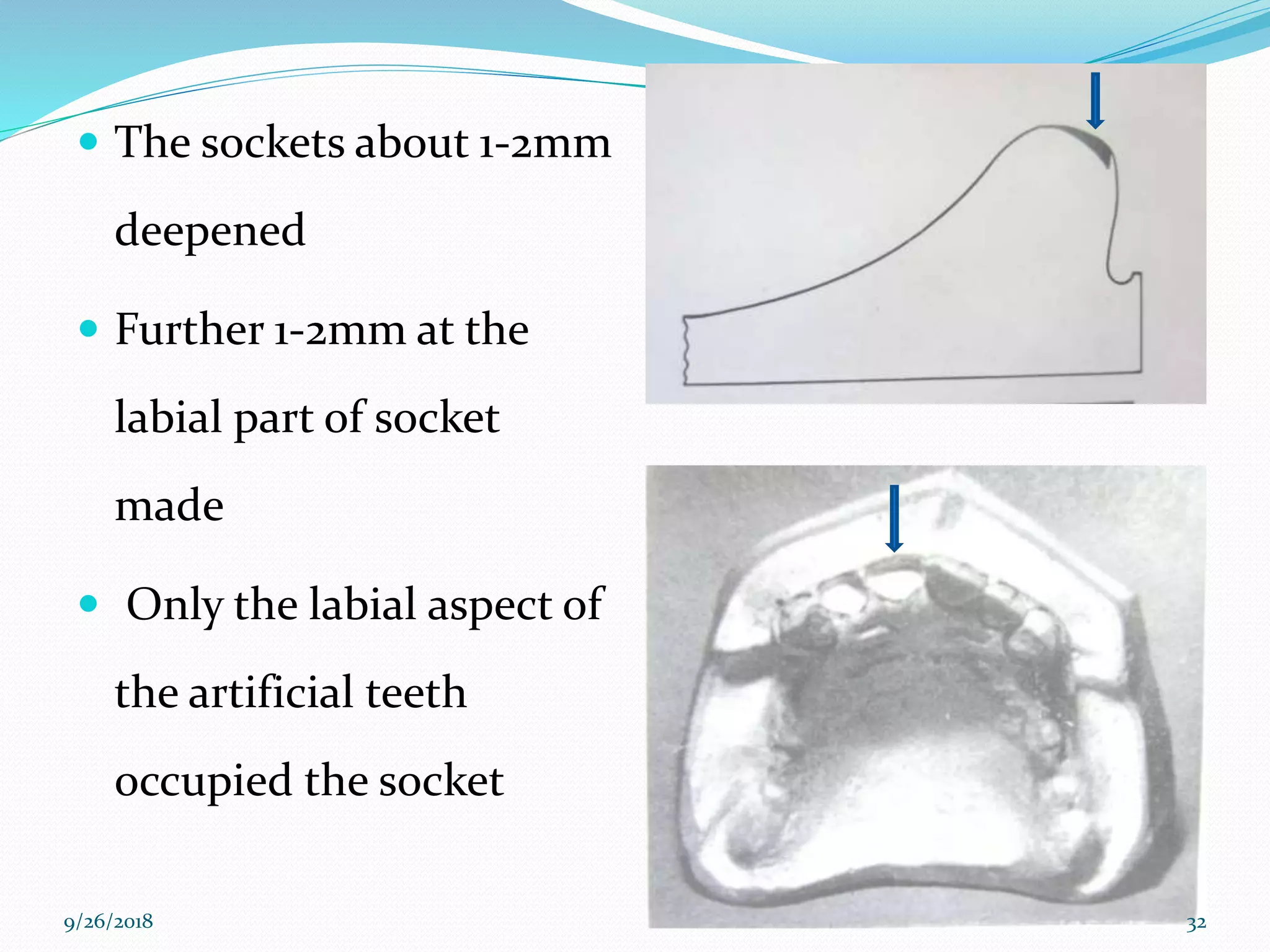 Immediate denture | PPTX