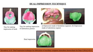 IMMEDIATE DENTURE power point presentation | PPTX