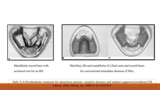 IMMEDIATE DENTURE power point presentation | PPTX