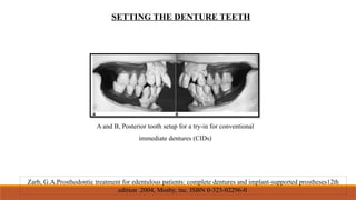 IMMEDIATE DENTURE power point presentation | PPTX