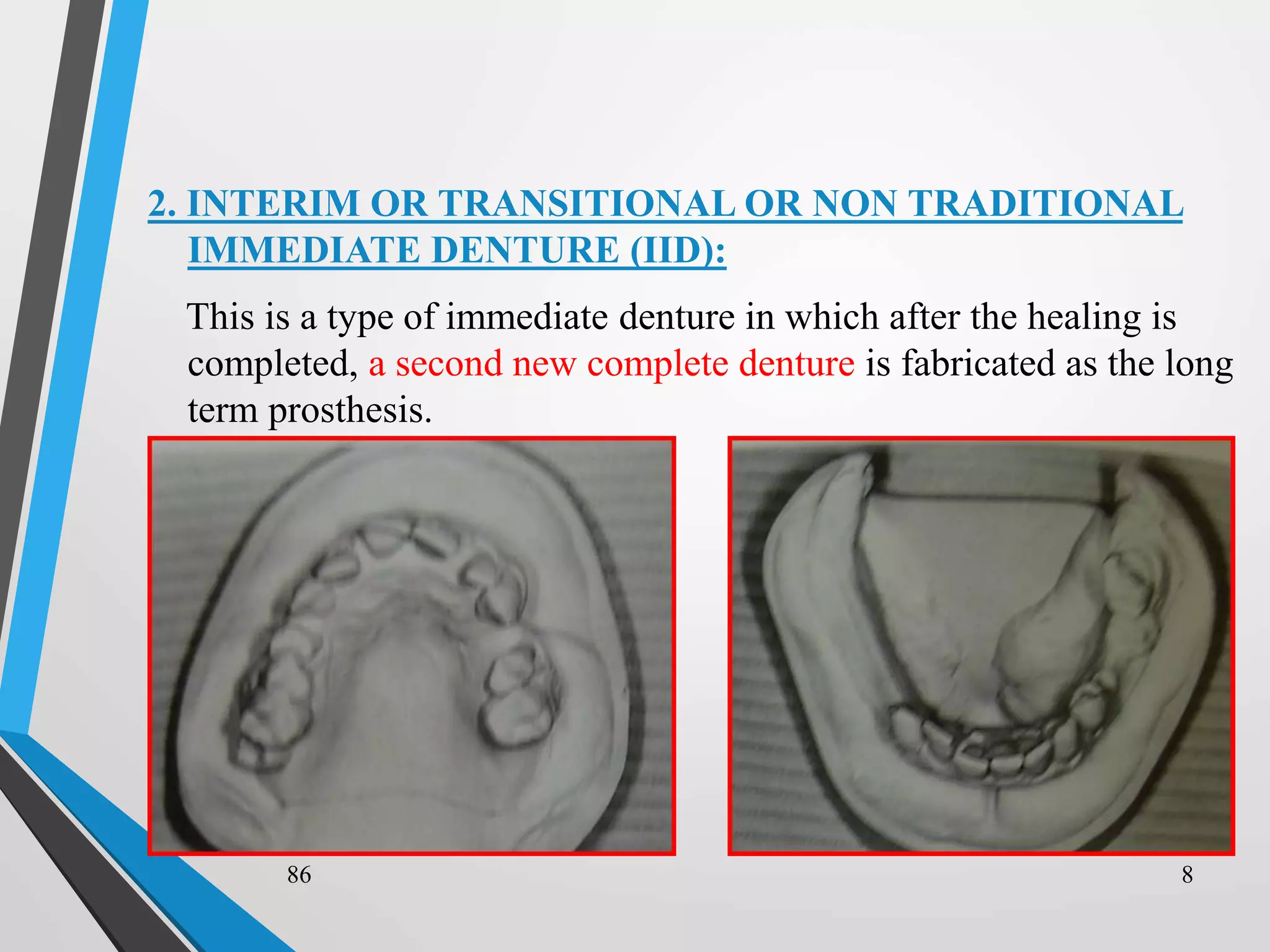 Immediate dentures | PPTX