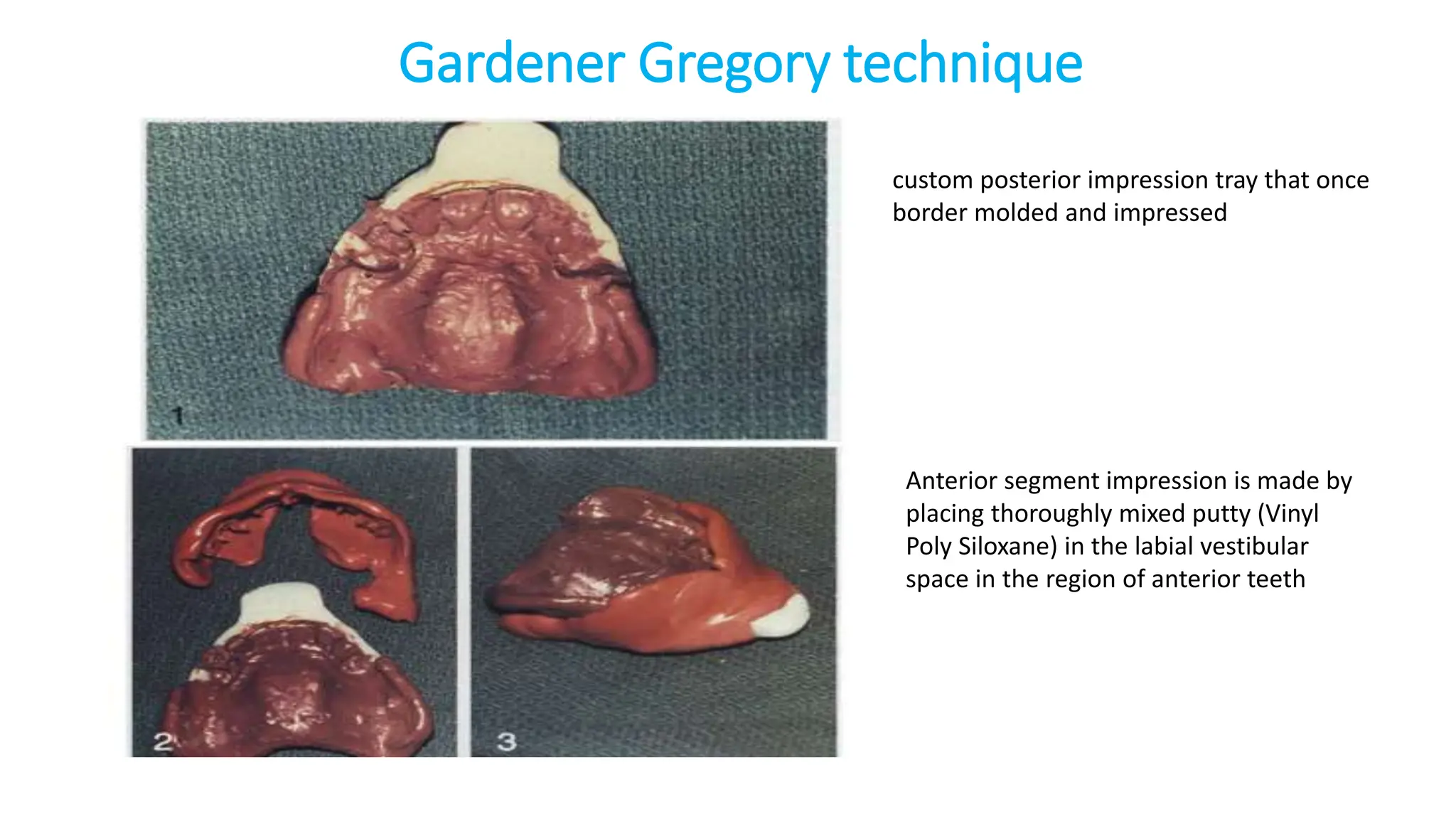 IMMEDIATE DENTURES and their classification | PPTX