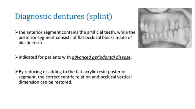 IMMEDIATE DENTURES and their classification | PPTX