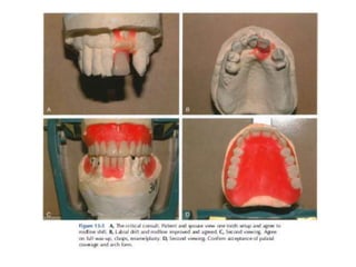 Immediate dentures revision class | PPT