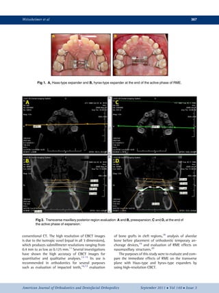 Immediate effects of rapid maxillary expansion with haas-type and hyrax ...