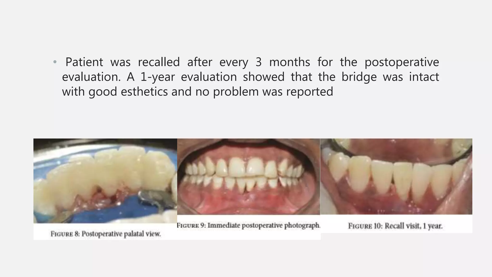 Immediate esthetic rehabilitation of periodontally compromised anterior ...