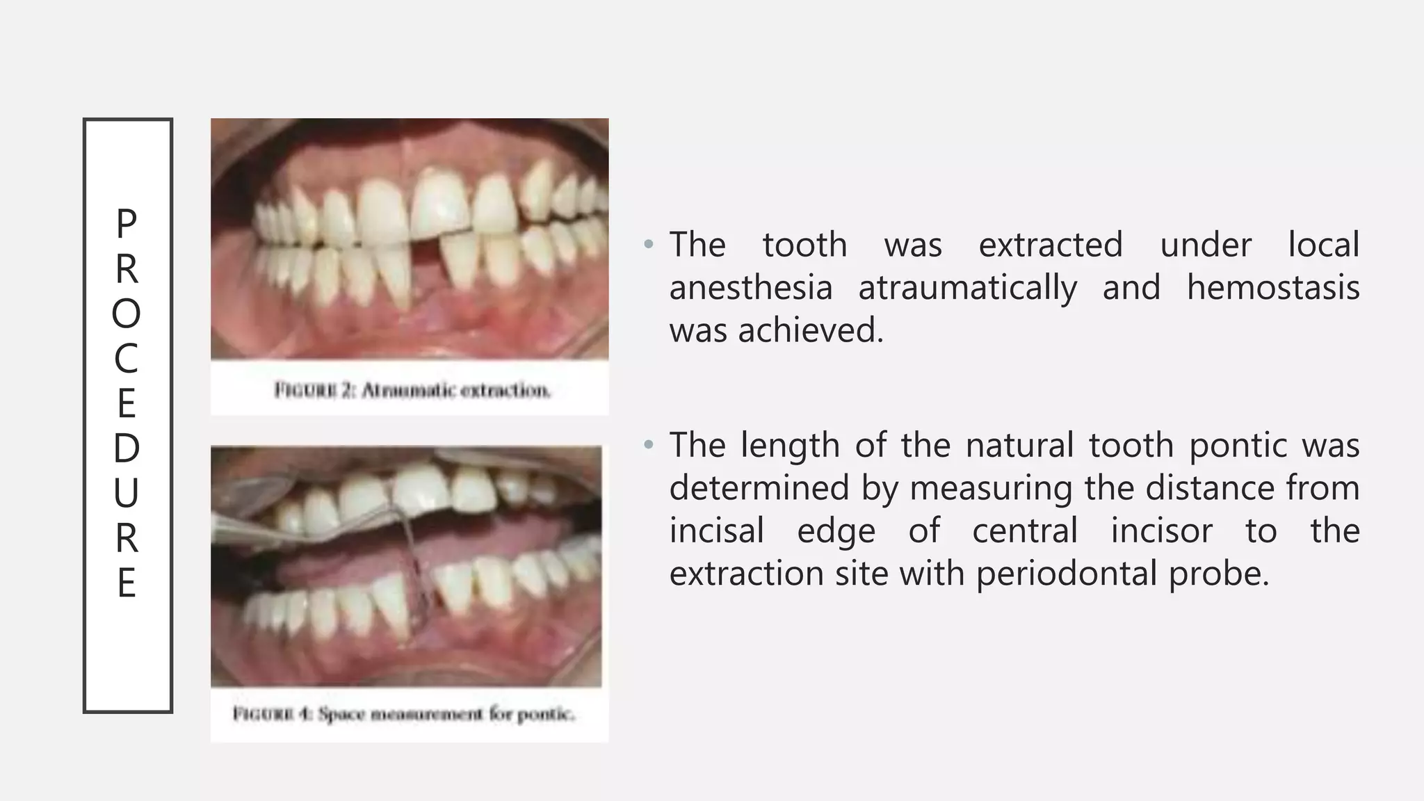 Immediate esthetic rehabilitation of periodontally compromised anterior ...