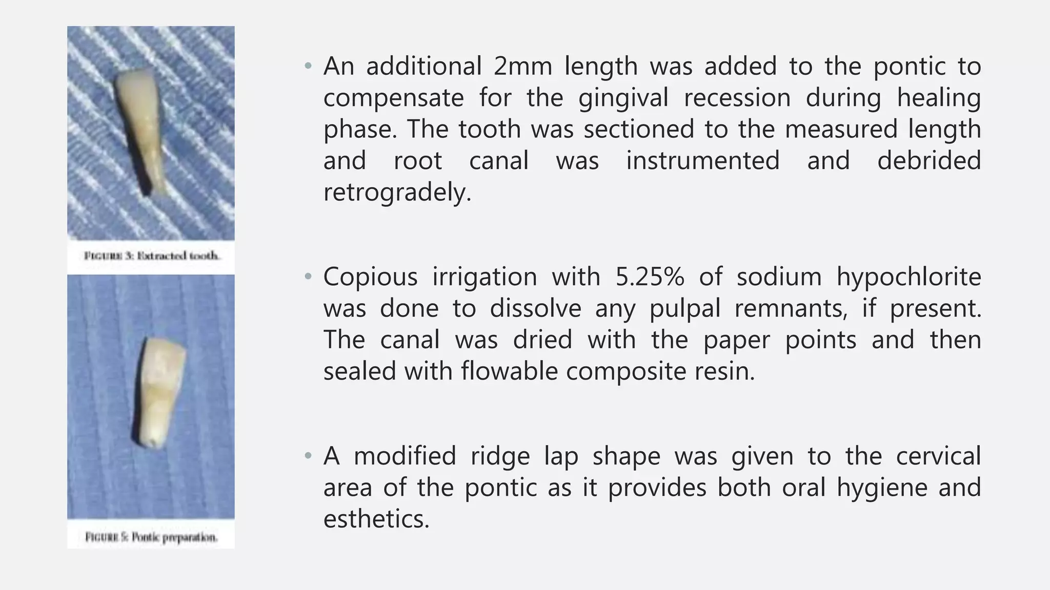 Immediate esthetic rehabilitation of periodontally compromised anterior ...