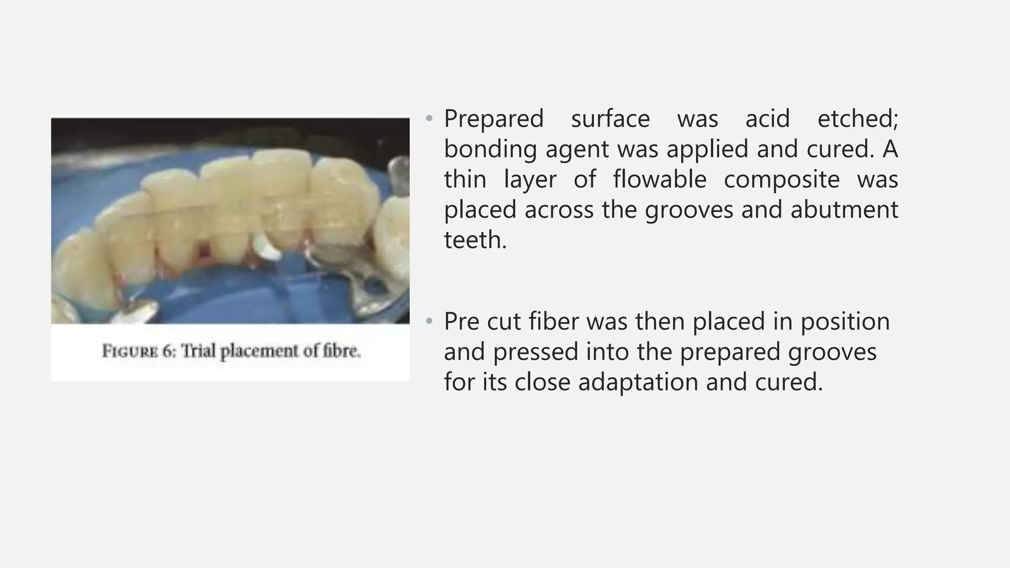 Immediate esthetic rehabilitation of periodontally compromised anterior ...