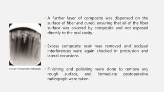 Immediate esthetic rehabilitation of periodontally compromised anterior ...