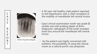 Immediate esthetic rehabilitation of periodontally compromised anterior ...