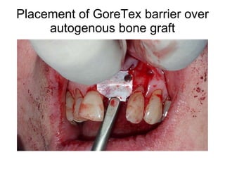 Immediate extraction ridge graft and implant placement | PPT | Dental ...