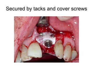 Immediate extraction ridge graft and implant placement | PPT | Dental ...