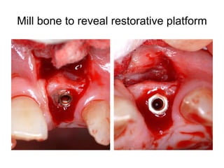 Immediate extraction ridge graft and implant placement | PPT | Dental ...
