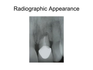 Immediate extraction ridge graft and implant placement | PPT | Dental ...