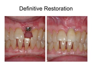 Immediate extraction ridge graft and implant placement | PPT | Dental ...