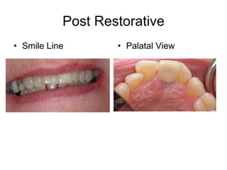 Immediate extraction ridge graft and implant placement | PPT | Dental ...