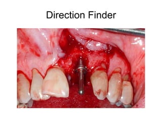 Immediate extraction ridge graft and implant placement | PPT
