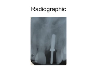 Immediate extraction ridge graft and implant placement | PPT | Dental ...