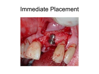 Immediate extraction ridge graft and implant placement | PPT | Dental ...
