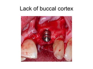 Immediate extraction ridge graft and implant placement | PPT | Dental ...