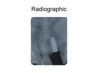 Immediate extraction ridge graft and implant placement | PPT | Dental ...