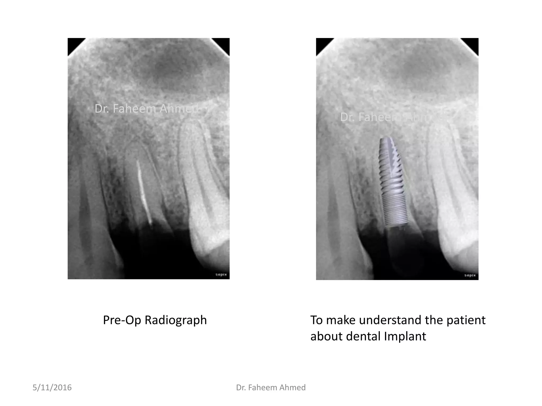Immediate implant | PPTX