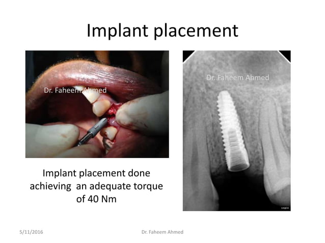 Immediate implant | PPT
