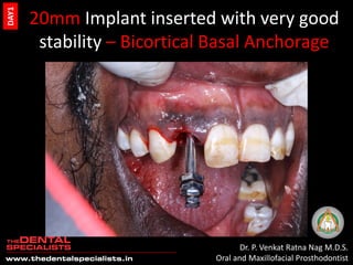 Immediate implantation and immediate loading with TTPHIL™ Technique | PDF