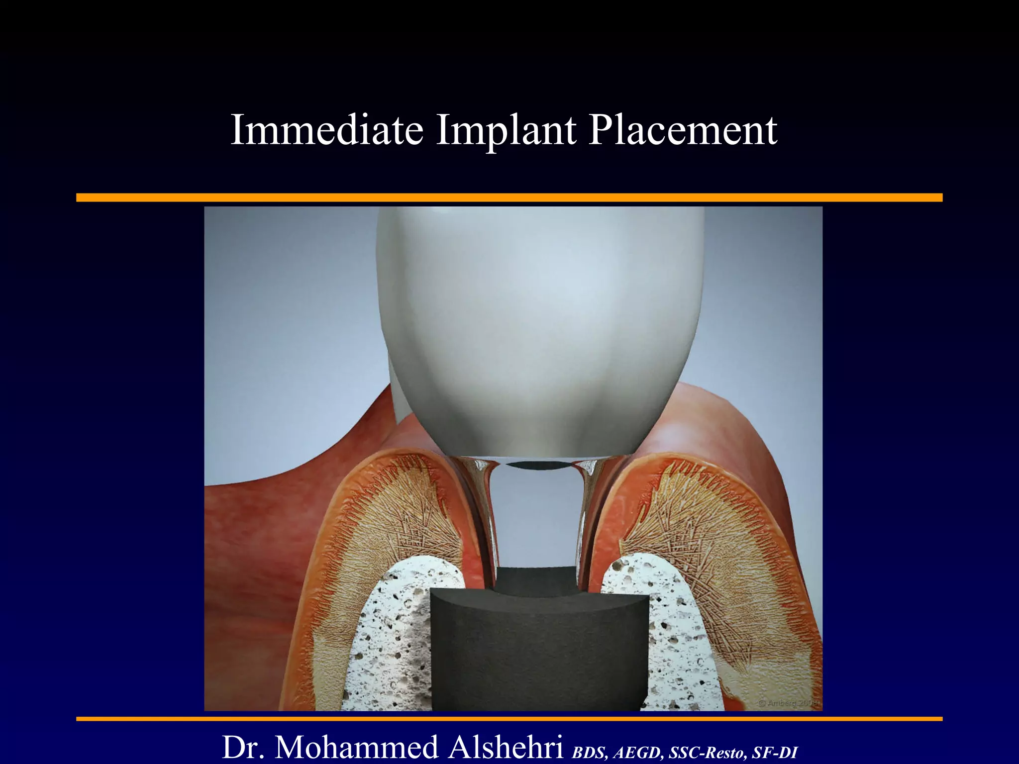 Immediate implant lecture | PPT