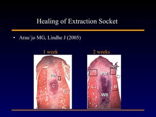 Immediate implant lecture | PPT