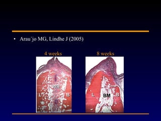 Immediate implant lecture | PPT