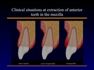 Immediate implant lecture | PPT
