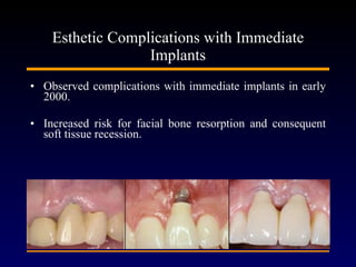 Immediate implant lecture | PPT